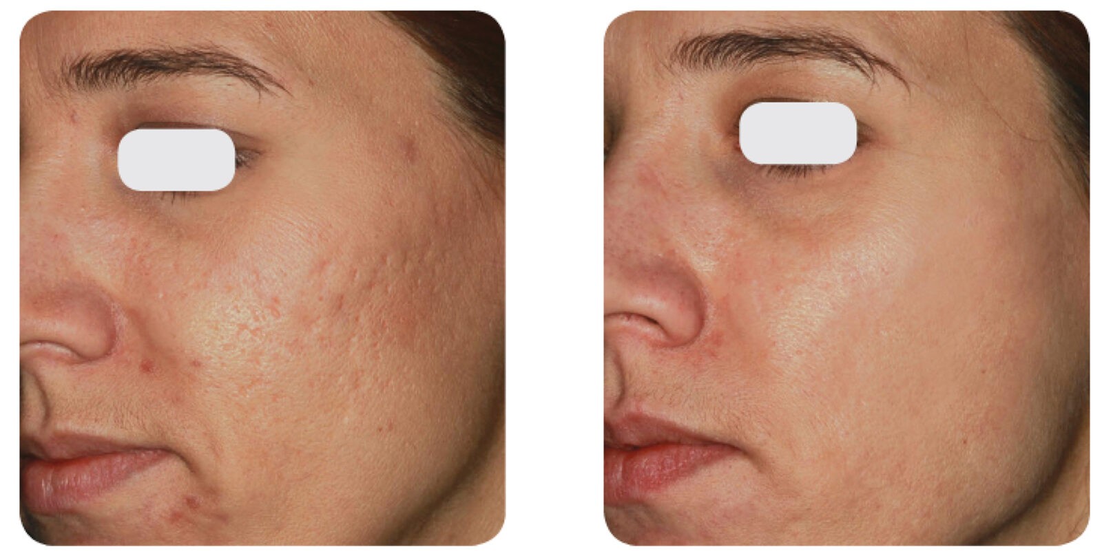 AcuPulse™ Versatility: guidelines and uses | PRIME Journal