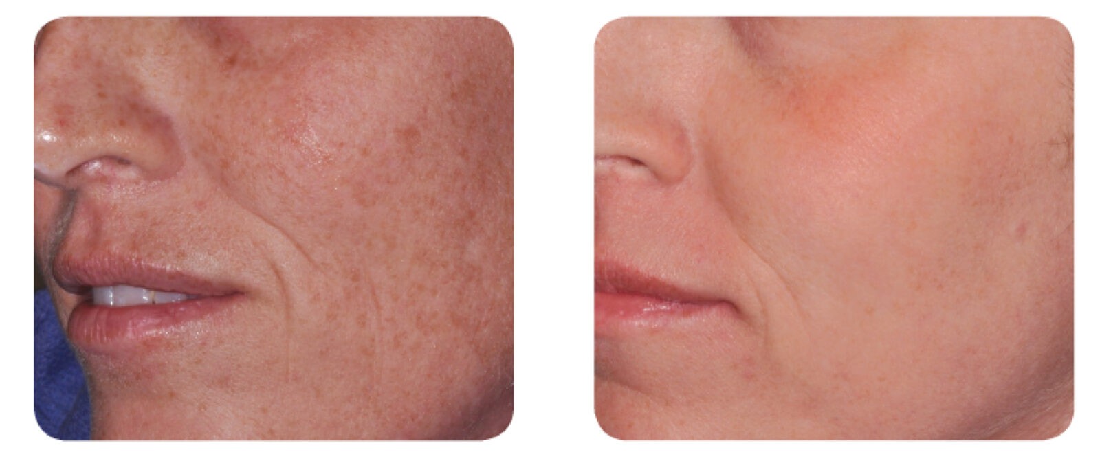 AcuPulse™ Versatility: guidelines and uses | PRIME Journal