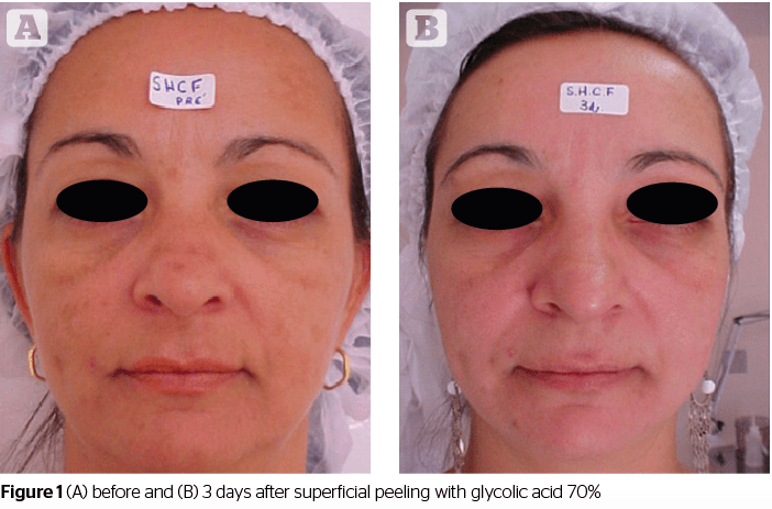 Pathophysiology of Chemical Peels | PRIME Journal