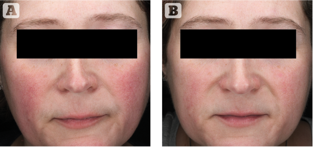 Light and Bright™ treatment of photodamaged skin and textural ...