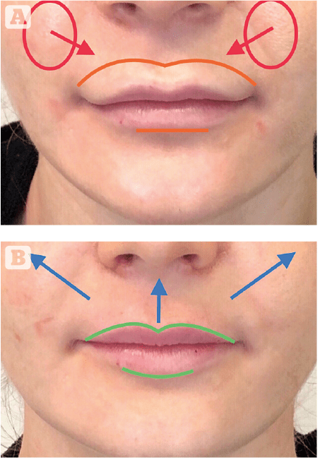 The Harris Classification of Filler Spread | PRIME Journal