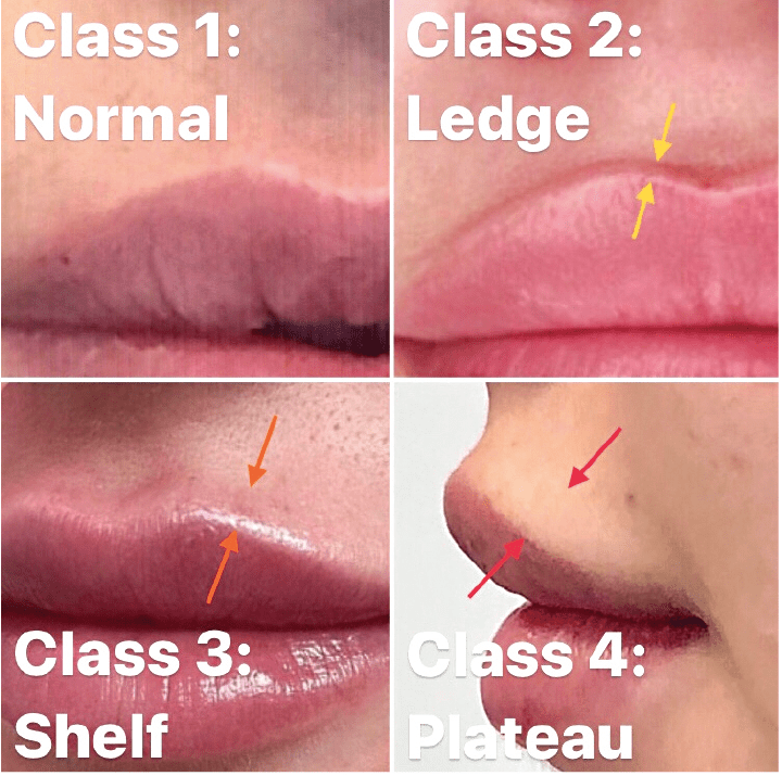 The Harris Classification of Filler Spread | PRIME Journal
